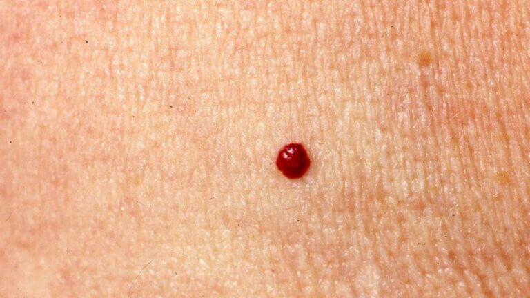 Why do moles appear on the body? How Do I Form? - CEOtudent