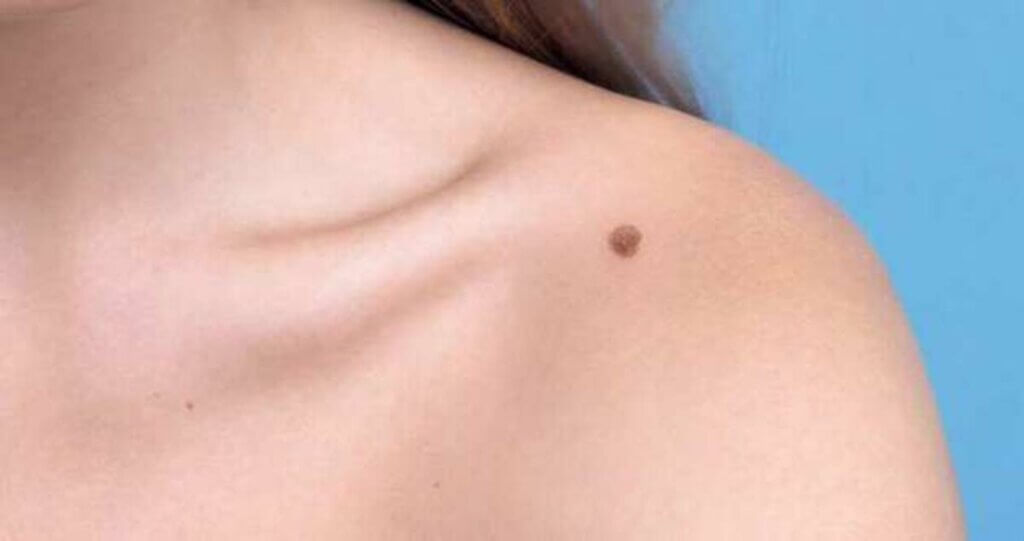 Why do moles appear on the body? How Do I Form? - CEOtudent